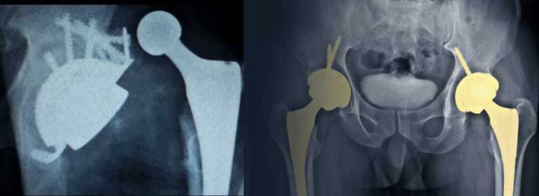 Hip Implant & Metal-on-Metal Lawsuits | Zimmer Biomet Recall