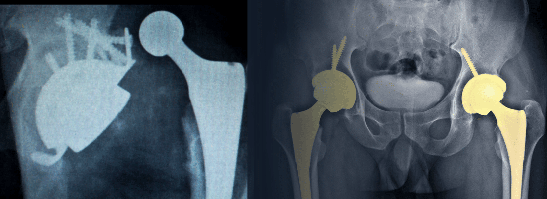 Hip Implant & Metal-on-Metal Lawsuits | Zimmer Biomet Recall
